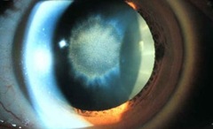 Medicine Decoded: Cataracts-Few interesting types